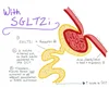 Navigating Indications and Contraindications of SGLT2 Inhibitors — When ...