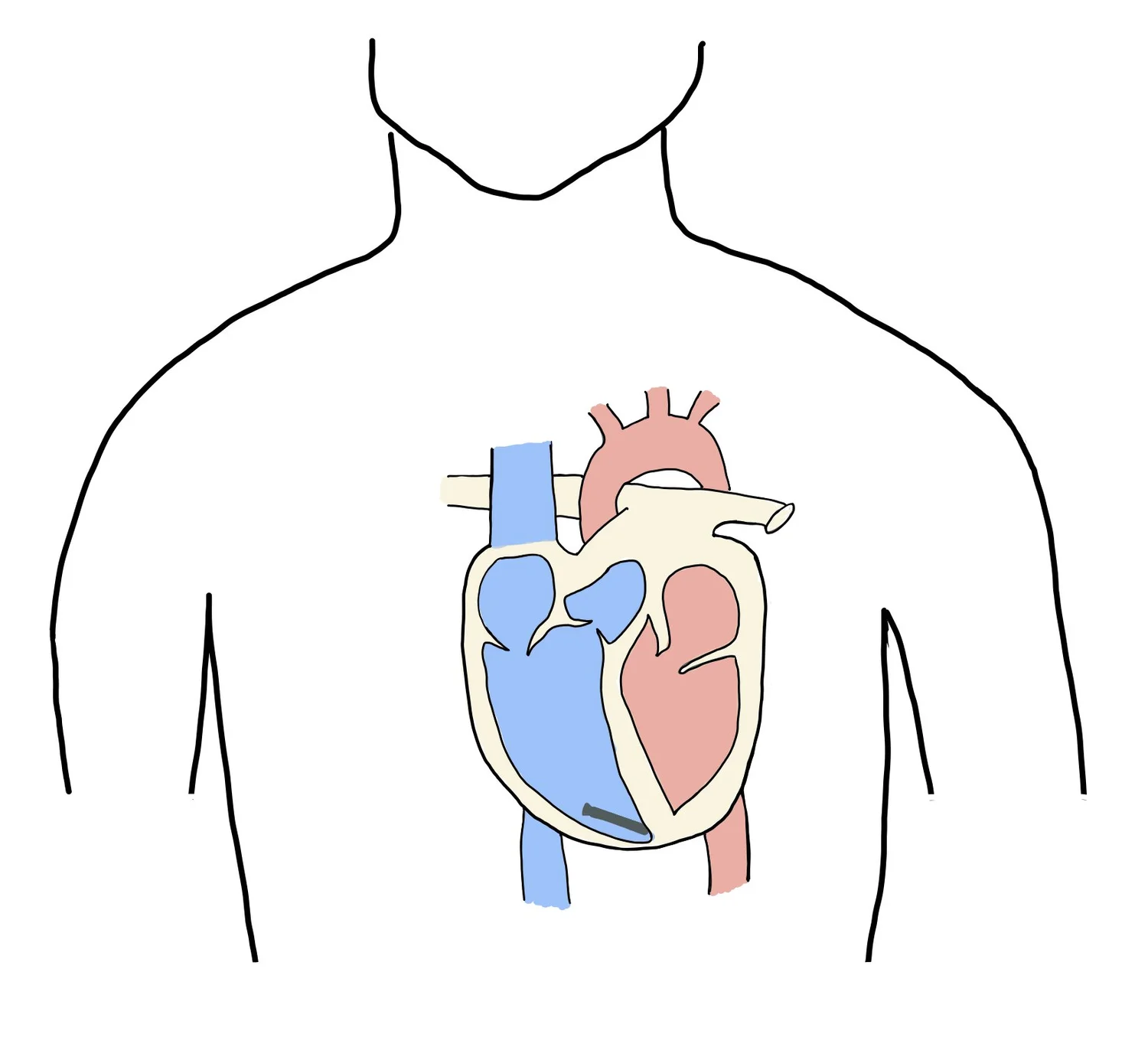 Bradycardia — When the Beat Drops: A Resident's Guide to the CCU