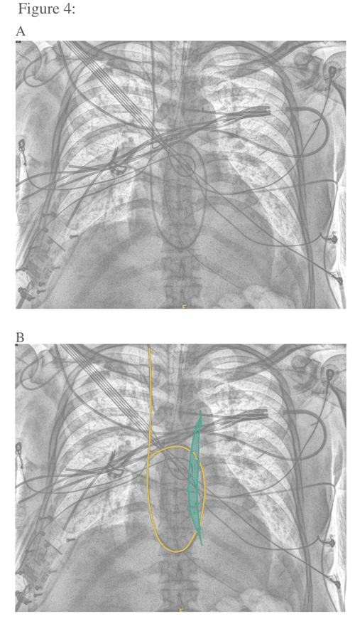 Mechanical Support: Impella and Balloon Pump — When the Beat Drops: A ...
