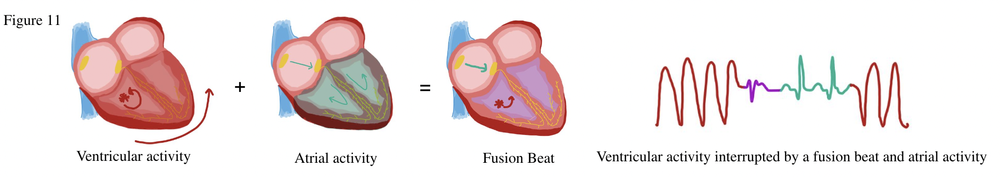 Wide Complex Tachycardia — When the Beat Drops: A Resident's Guide to ...