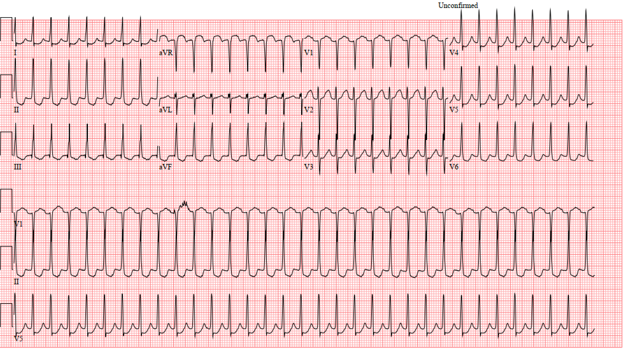 SVT: AVRT vs AVRNT — When the Beat Drops: A Resident's Guide to the CCU