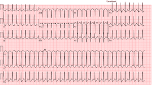 SVT: AVRT vs AVRNT — When the Beat Drops: A Resident's Guide to the CCU