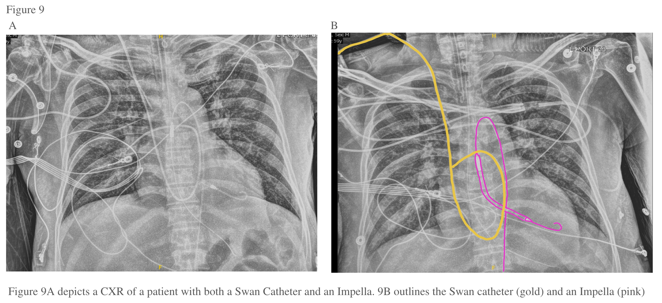 Pulmonary Artery Catheters / Swans — When the Beat Drops: A Resident's ...