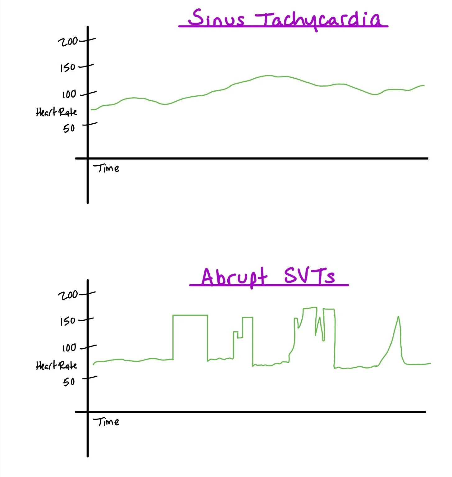 SVT: AVRT vs AVRNT — When the Beat Drops: A Resident's Guide to the CCU