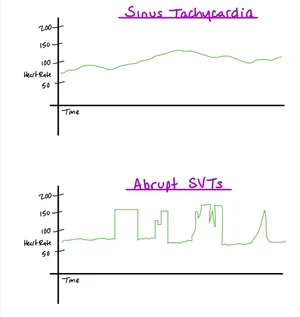SVT: AVRT vs AVRNT — When the Beat Drops: A Resident's Guide to the CCU