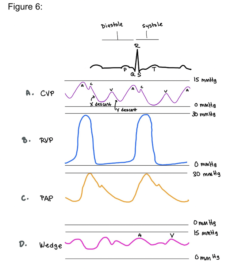 Pulmonary Artery Catheters / Swans — When the Beat Drops: A Resident's ...