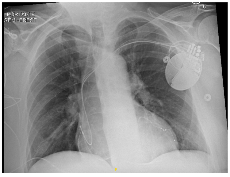 Pacemakers and ICDs — When the Beat Drops: A Resident's Guide to the CCU