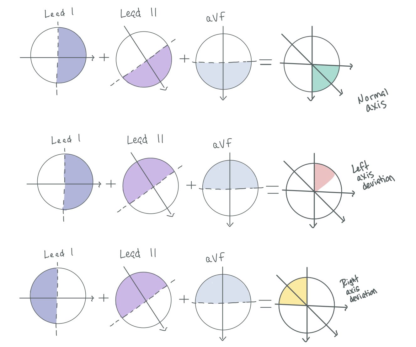 How to Read EKGs — When the Beat Drops: A Resident's Guide to the CCU