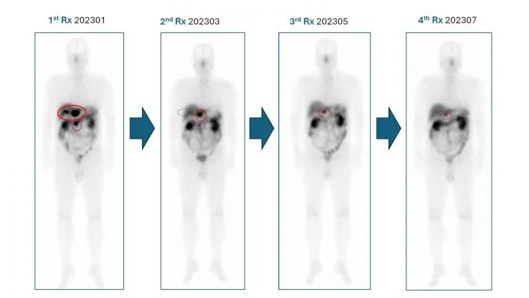 Neuroendocrine Tumors and PRRT Treatment — Taiwan Cancer Care