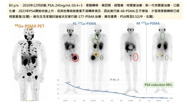 Remarkable Recovery: Lutetium-177-PSMA Therapy Helps 85-Year-Old ...