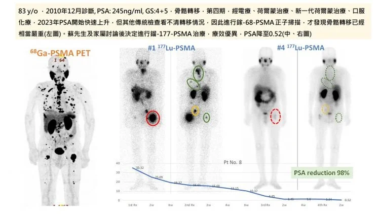 Remarkable Recovery: Lutetium-177-PSMA Therapy Helps 85-Year-Old ...