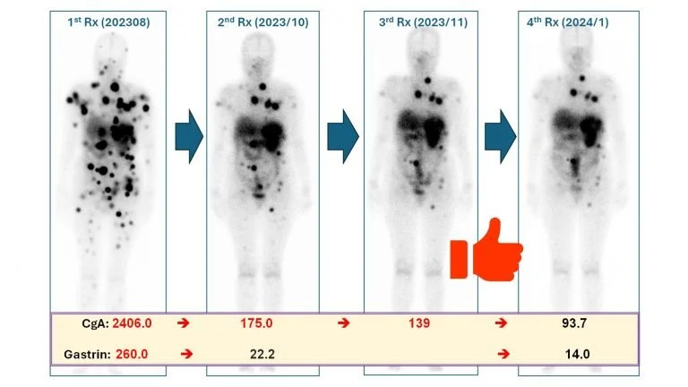 Neuroendocrine Tumors and PRRT Treatment — Taiwan Cancer Care