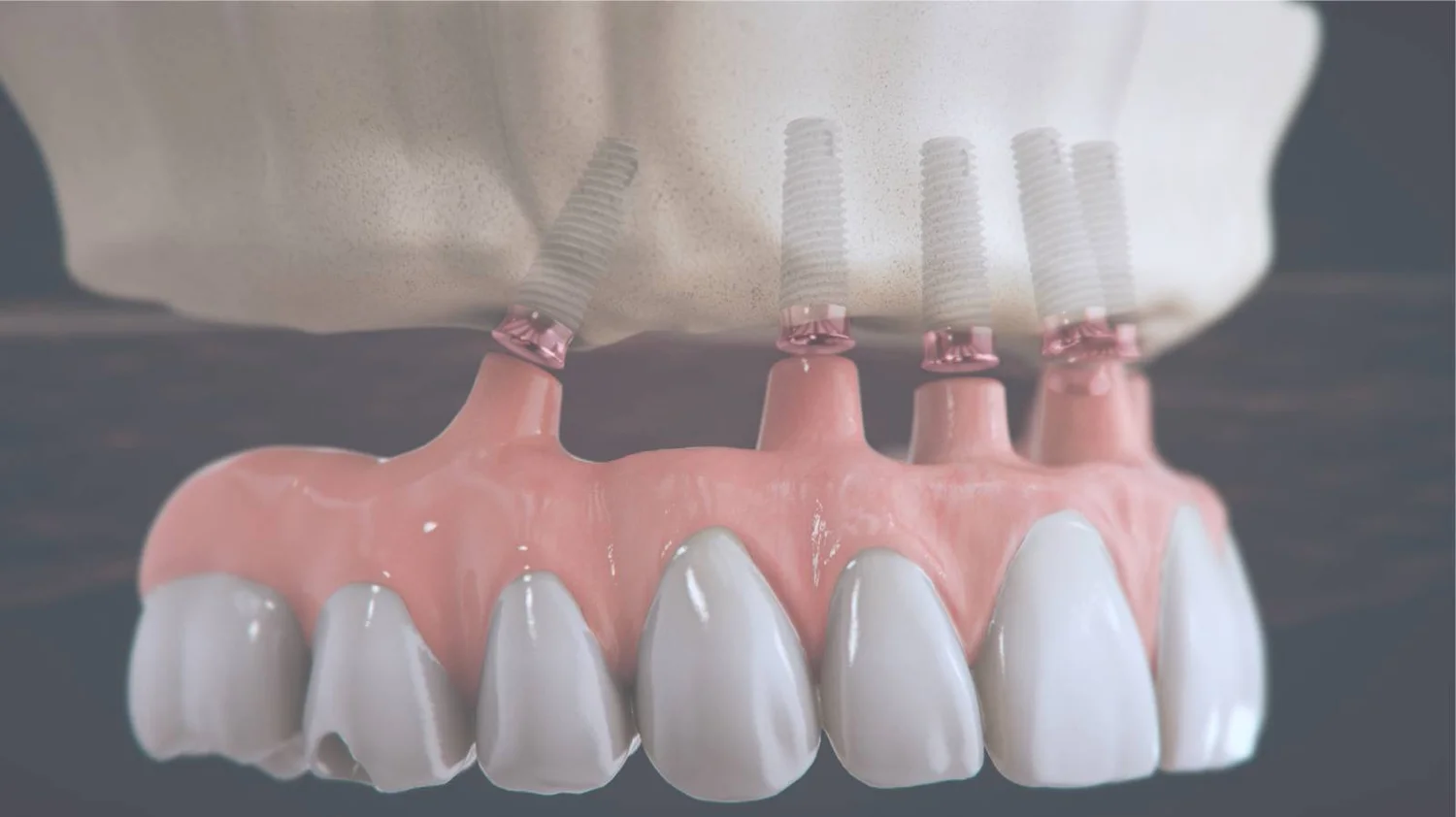 TRI-Dental Implants range — TRI Dental ANZ