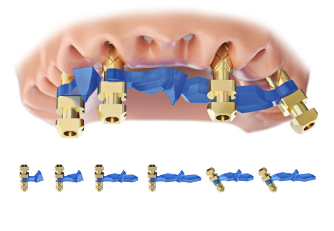 TRI-Dental Implants range — TRI Dental ANZ