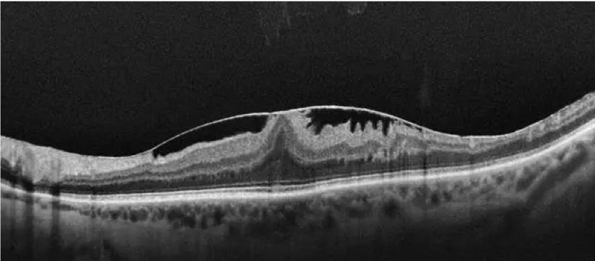 Surgical Retina Ed Casswell Ophthalmology — Home