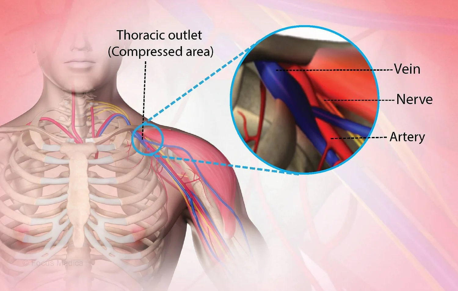 Thoracic outlet syndrome (TOS) and improvement with a non-invasive ...