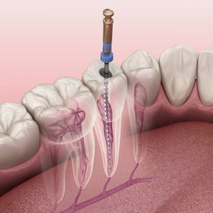 Root Canal Treatment — Broadway Dental Surgery