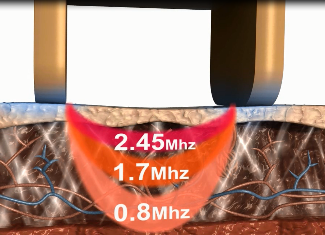 Radiofrequency I Cael Revive Spa I Medspa I Orange County, CA I IPL I ...