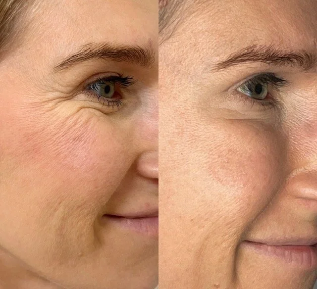 Botox hoidot | Botuliinihoidot | Pure Med Esthetics Hyvinkää — Pure Med ...