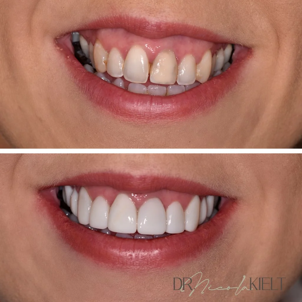 Same Day Smile Makeover with Composite Bonding. Smile design. Belfast ...
