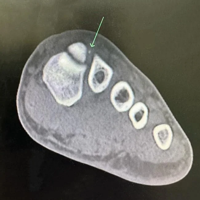 Lisfranc Injury Surgery — Associate Professor Roderick Kuo