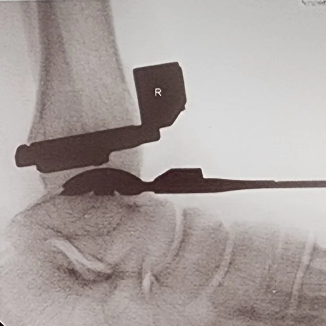 Ankle Replacement Surgery — Associate Professor Roderick Kuo