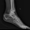 Ankle Fracture Surgery — Associate Professor Roderick Kuo