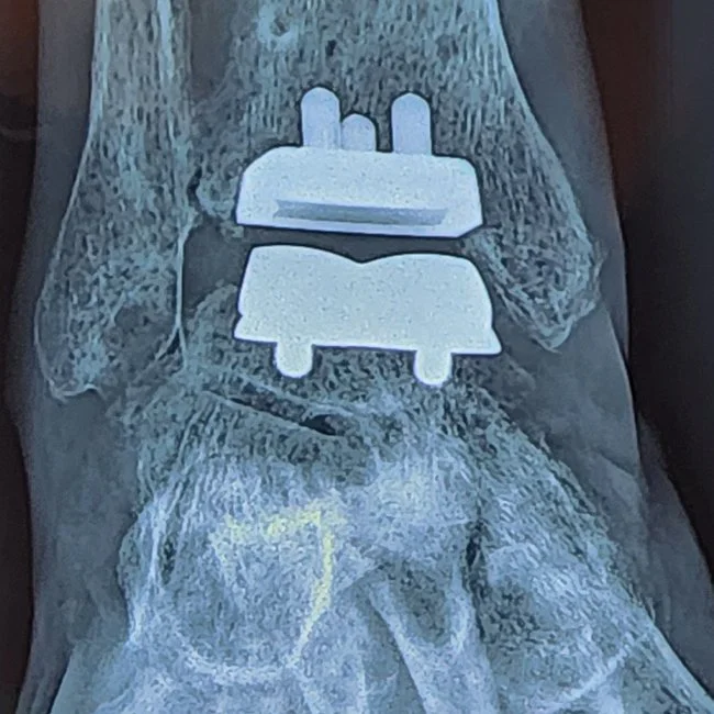 Ankle Replacement Surgery — Associate Professor Roderick Kuo