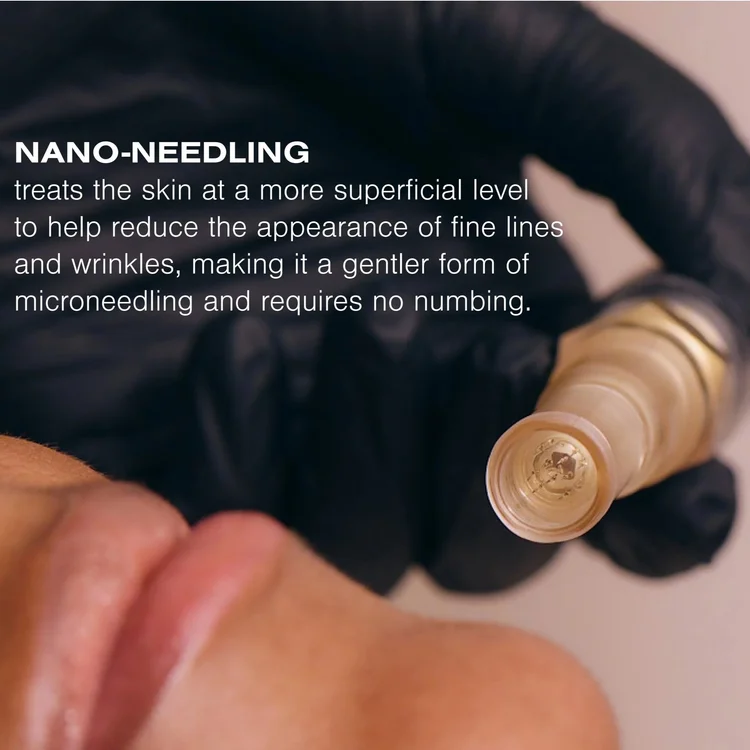 Nano Needling vs. Microneedling: Which Treatment is Right for You ...