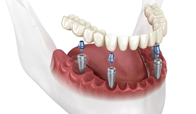 Implant Dentures in Arizona | Tooth Corps