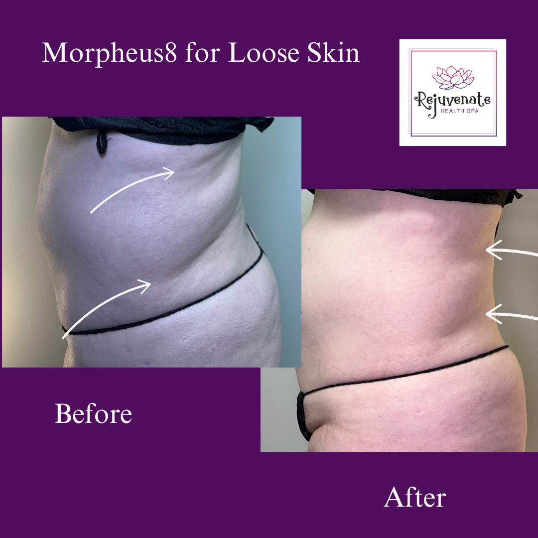 Morpheus8 Face and Body — Rejuvenate Health Spa