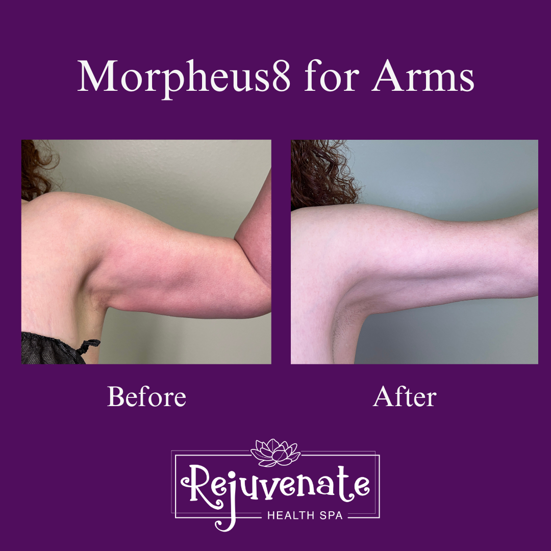Morpheus8 Face and Body — Rejuvenate Health Spa