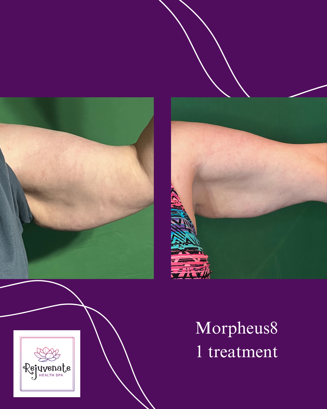 Morpheus8 Face and Body — Rejuvenate Health Spa