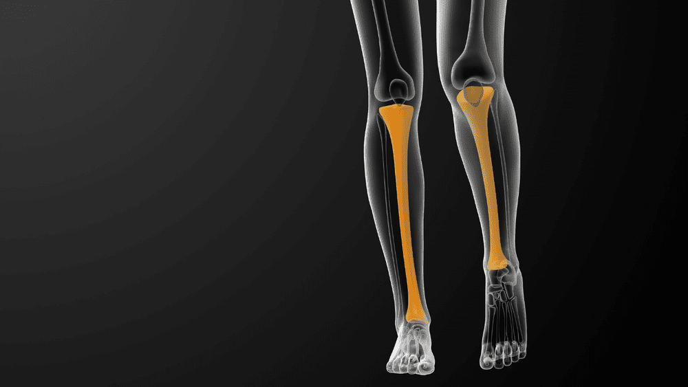 A Pain in the Shin — Carlingford Active Health