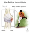 Understanding UCL Sprains and Their Management for Little Athletics ...