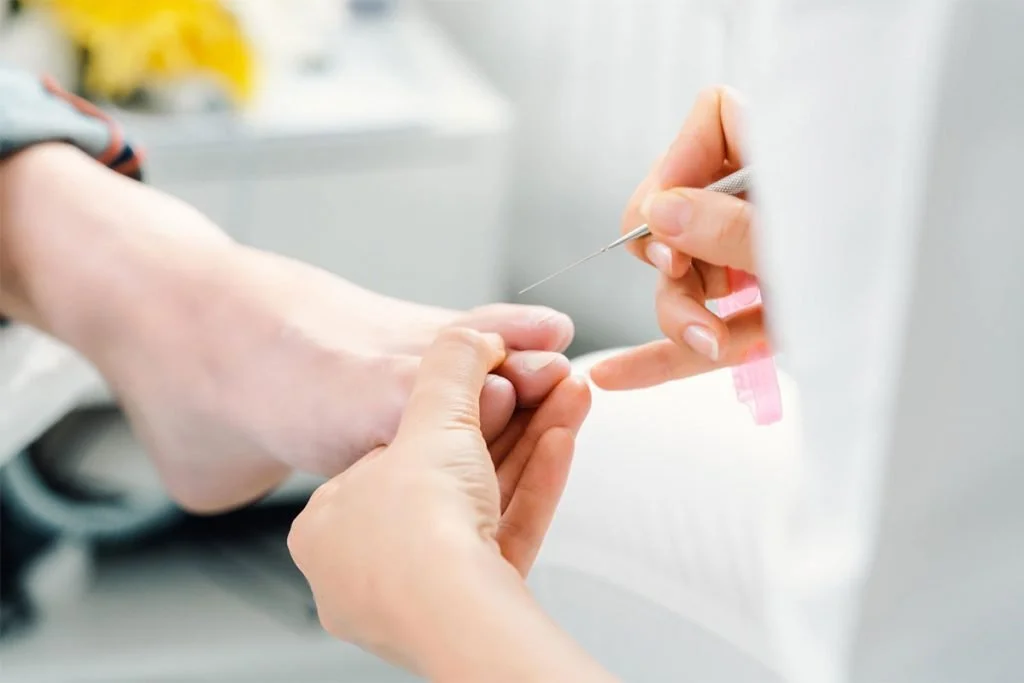 Ingrown Toenail Treatment Brisbane | Pain Relief & Care | Studio ...