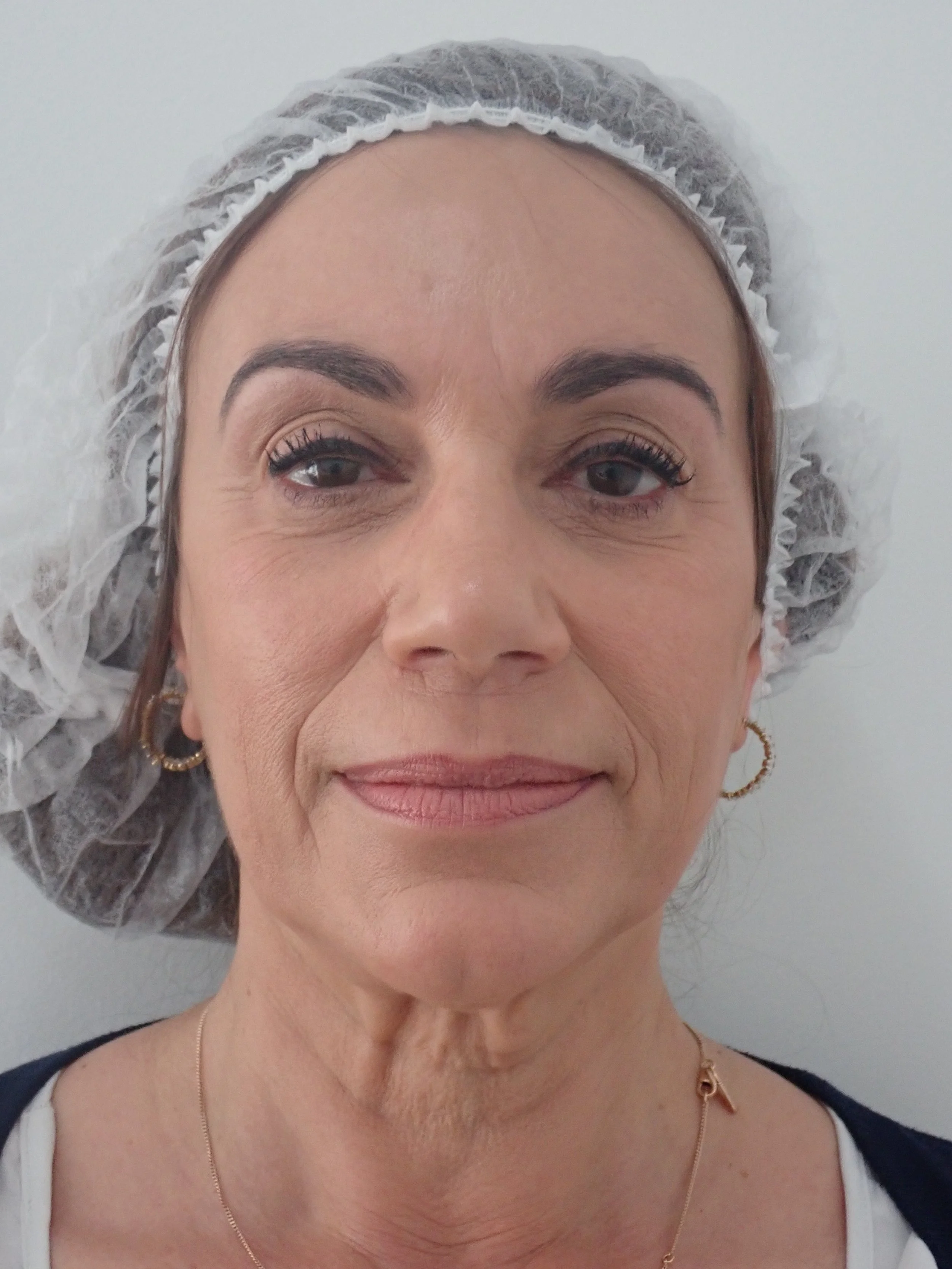 Skin Needling — Skindeep Clinic