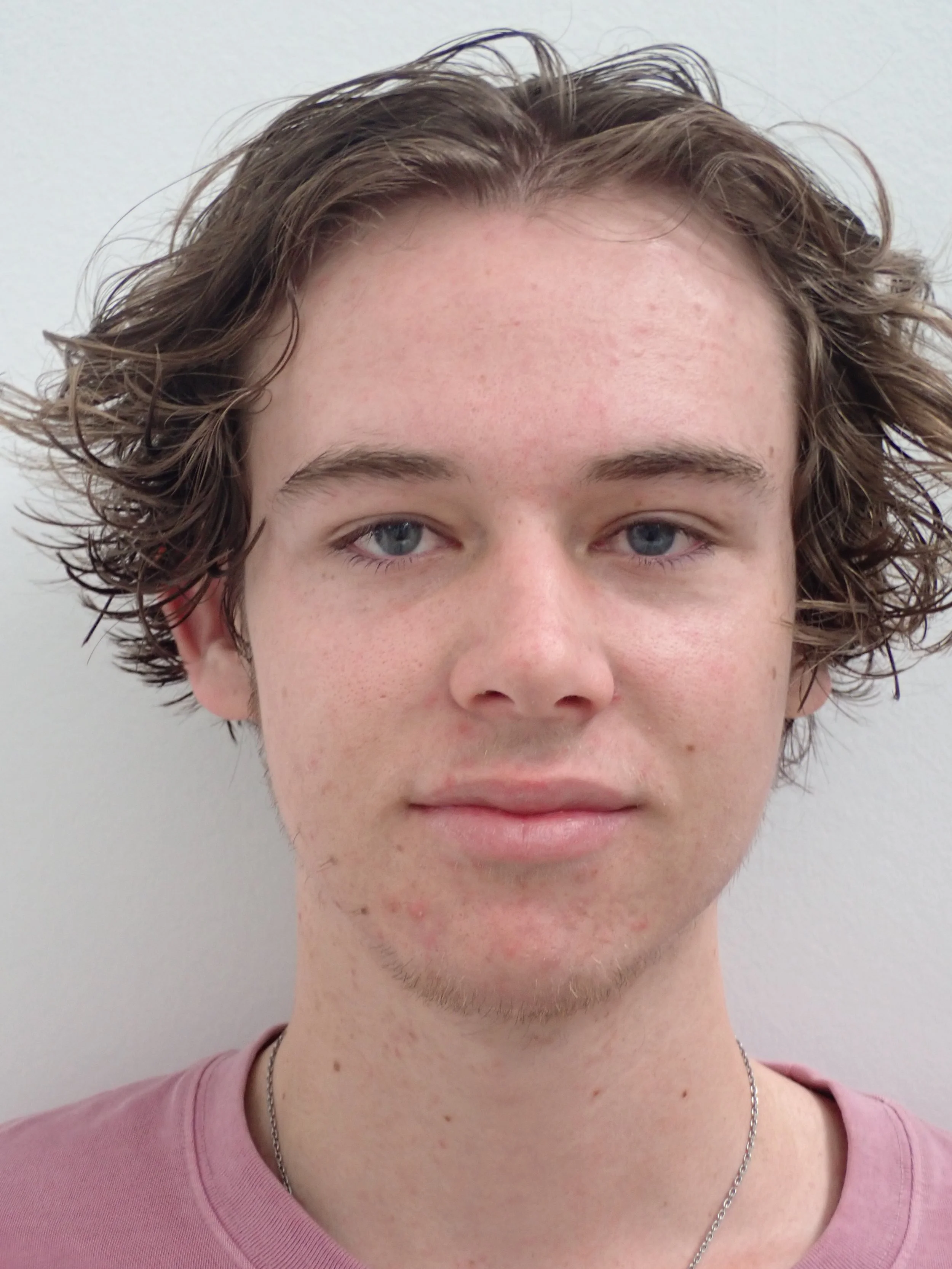 Skin Needling — Skindeep Clinic