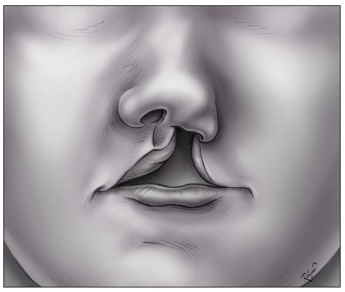 Dr. Luis Gerardo Sandoval: Cirugías de Labio y Paladar Fisurado con en Perú