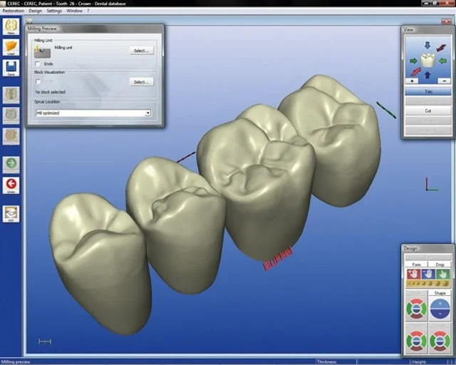 CEREC One Visit Dental Crowns | Dentist in South Austin