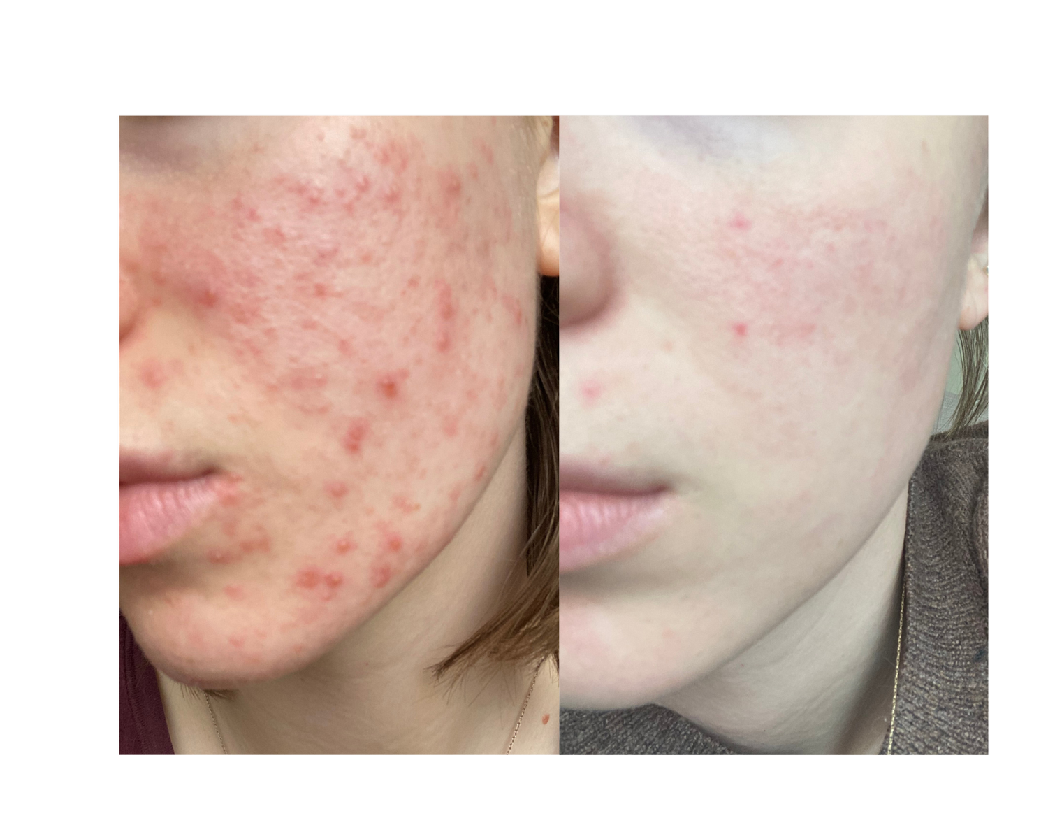 How I Finally Cleared My Acne After Years of Struggling — Adventure ...