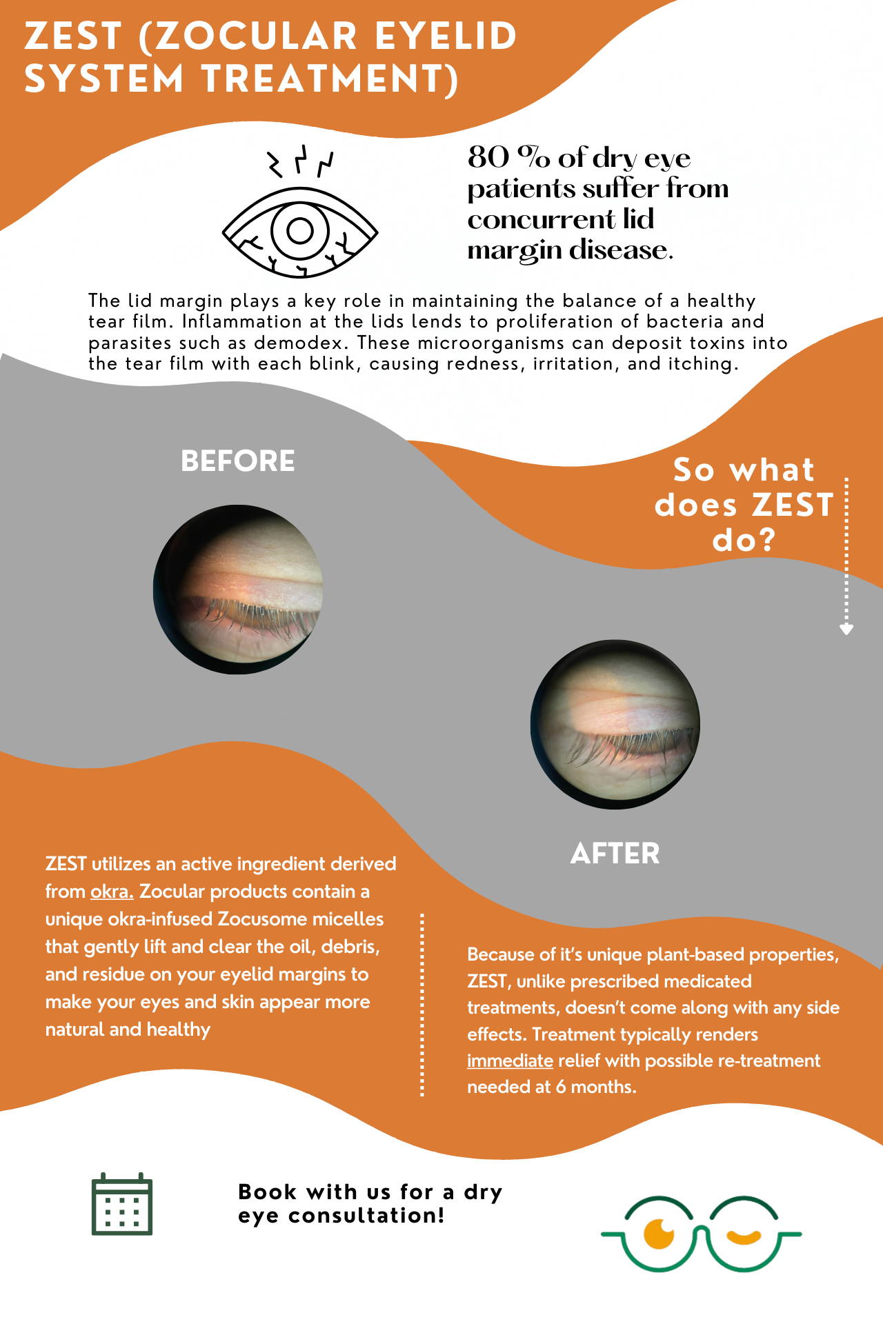 ZEST treatment — Wink Optical and Eye Care