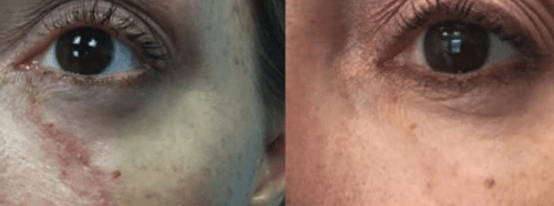 Rejuran for Acne Scars Around the Eyes: What You Should Know — TT ...