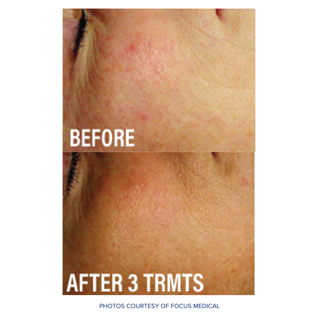 NaturaLight IPL — FOCUS MEDICAL