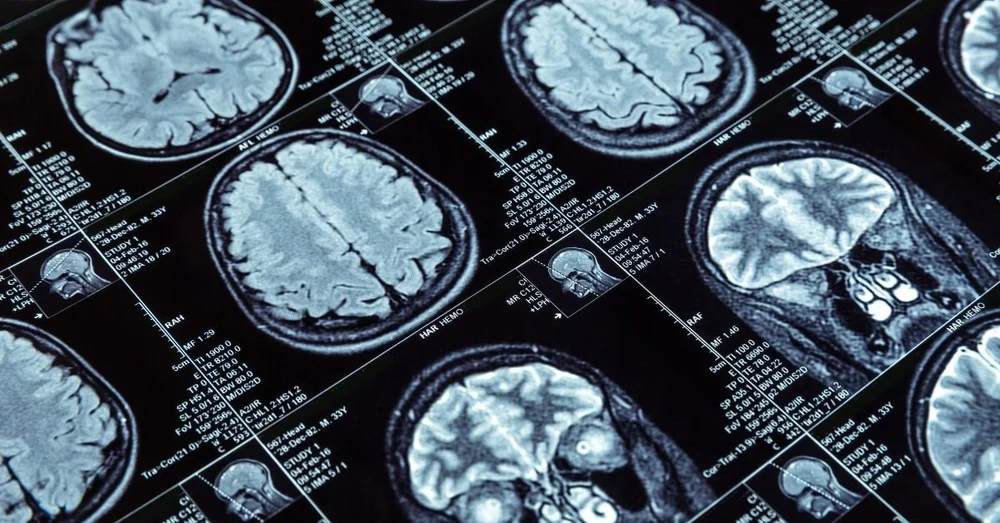 TMS Therapy: Exploring Advanced Techniques | Solstice — Solstice ...