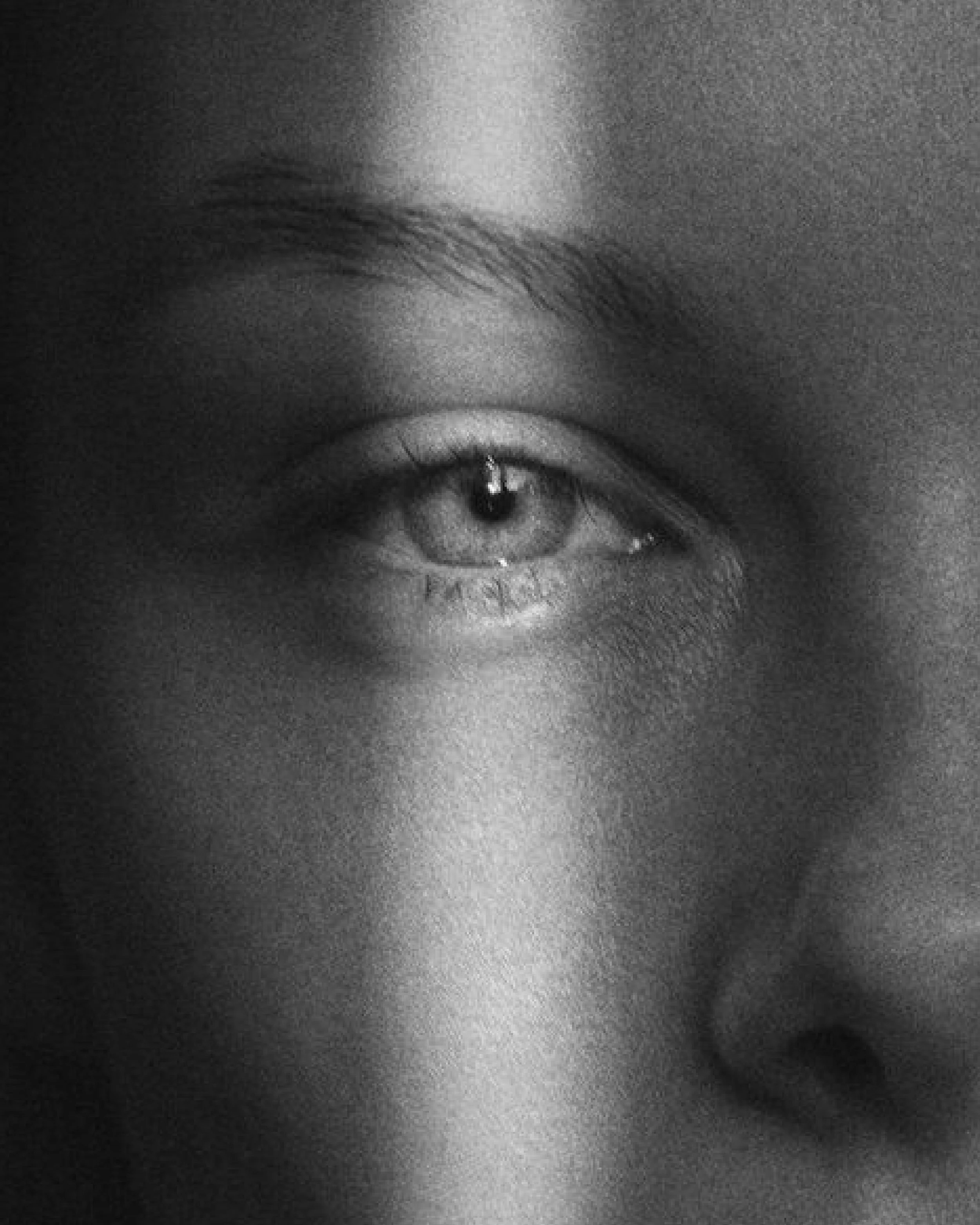 Eye Surgery / Ptosis / Under-eye — SIAMSWAN