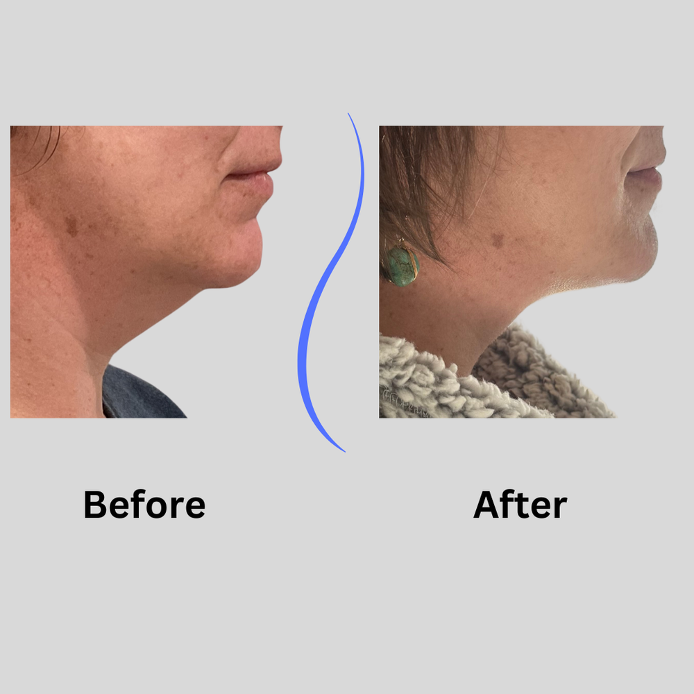 Chin & Neck Fat Removal — Blue Wolf Transformations