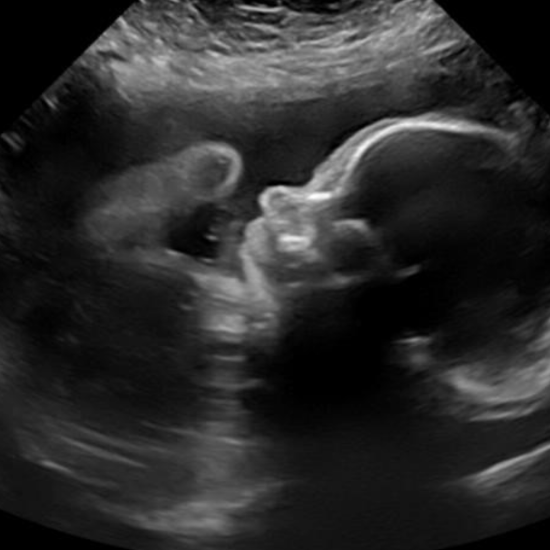 Understanding the Benefits of 2D Ultrasounds for Expecting Moms ...