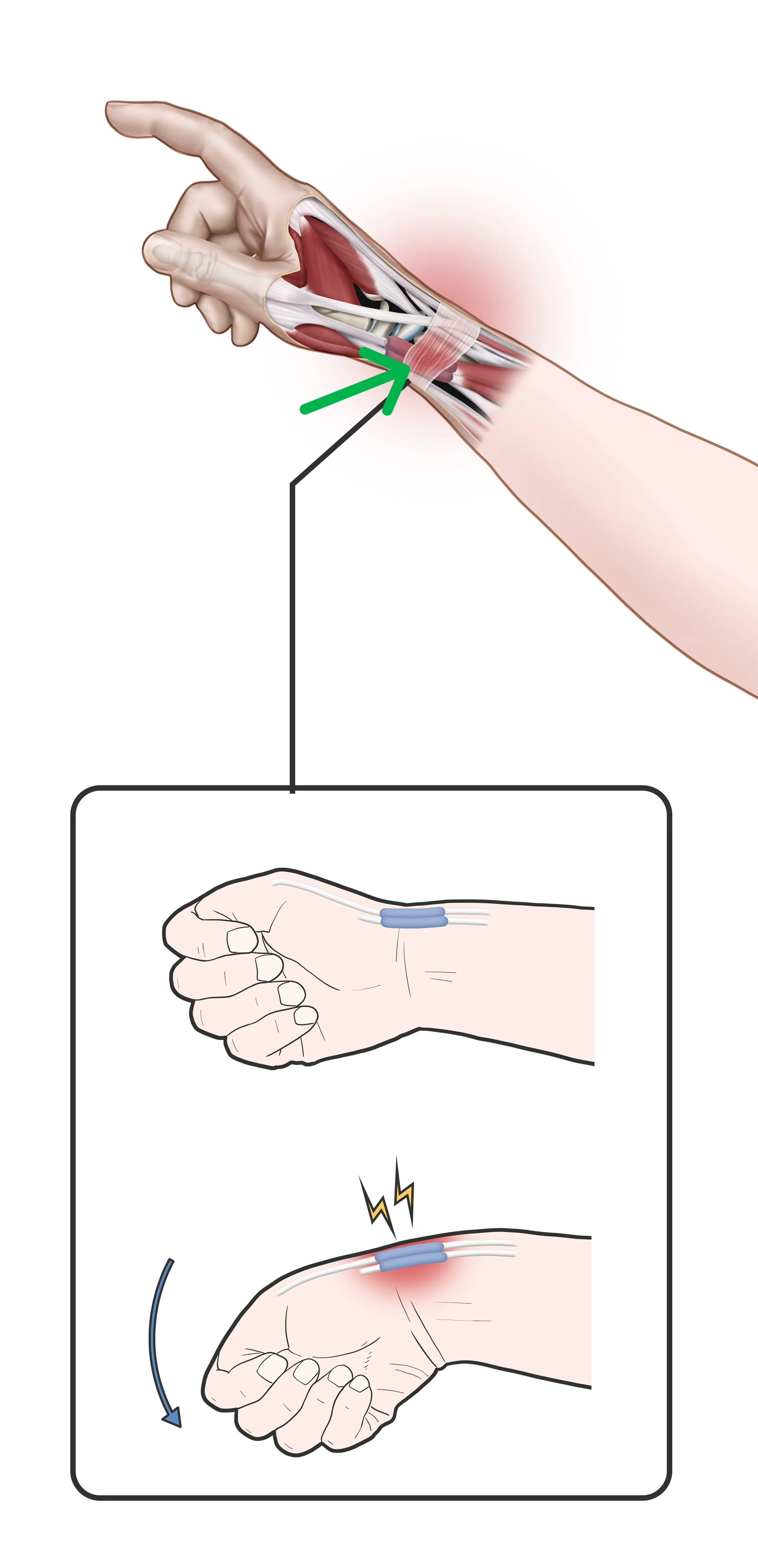 Tendinite de DeQuervain — Dr Sturbois Nachef