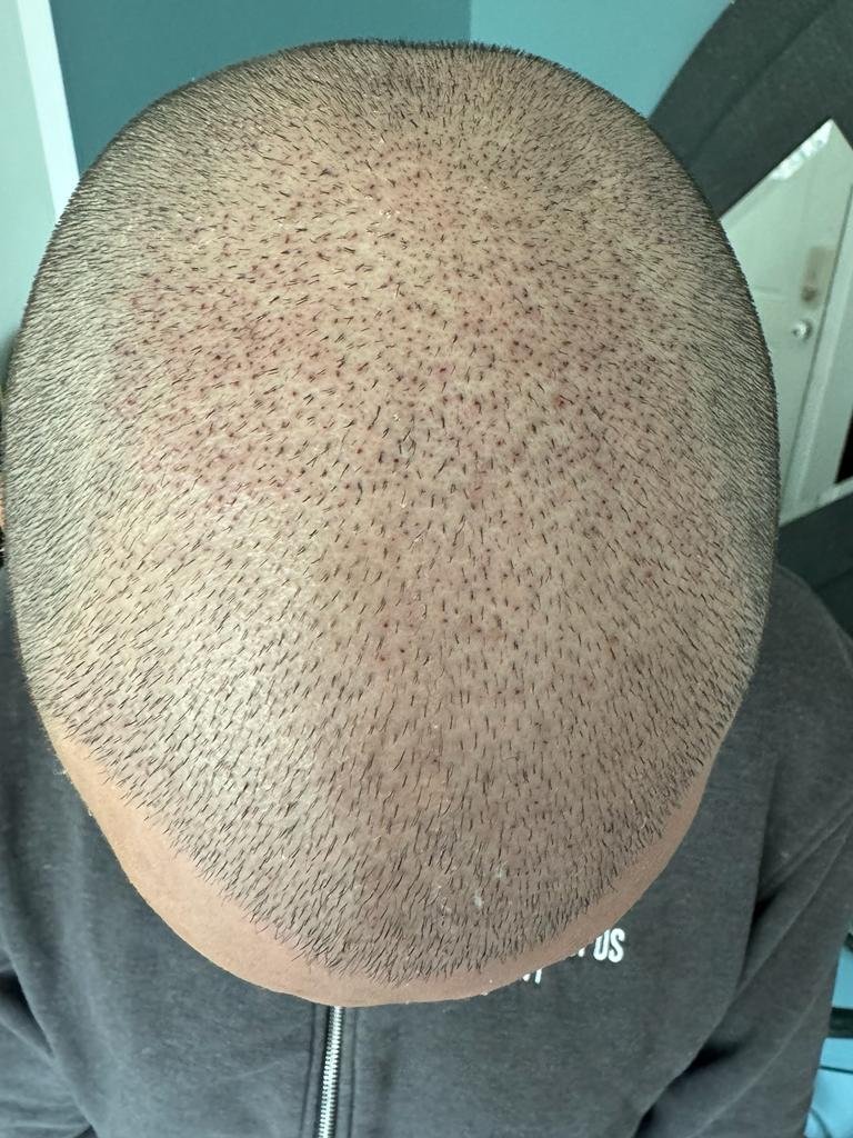 SMP Hair Tattoo by: iNKED iLLUSiONS. Transformative Scalp ...